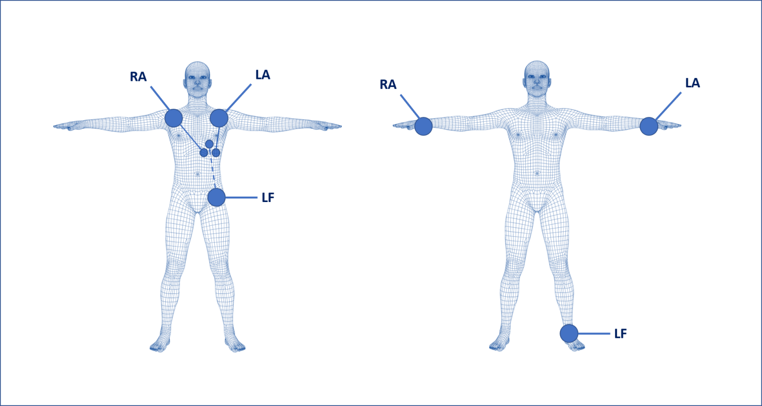 Where should I place my Electrocardiography (ECG) electrodes?